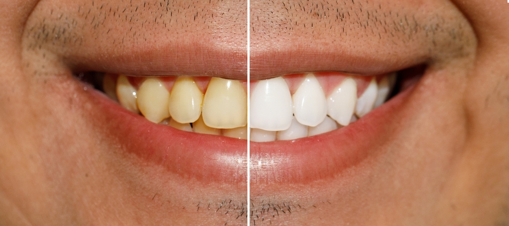 Teeth Whitening in Rocky River | Cosmetic Dentist Near You